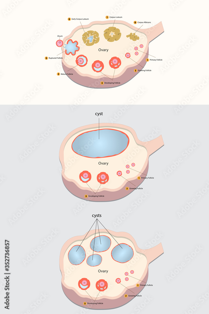 Normal ovary and ovarian cysts diagram vector design. Stock Vector ...