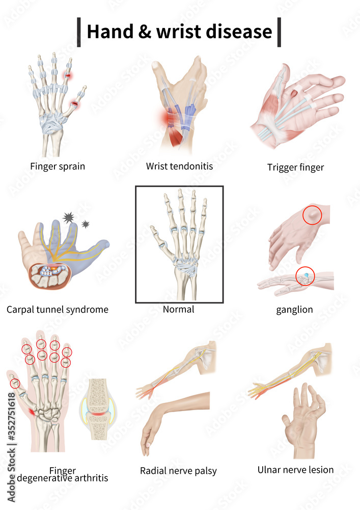 Medical illustration explaining Hand & wrist disease Stock Illustration ...