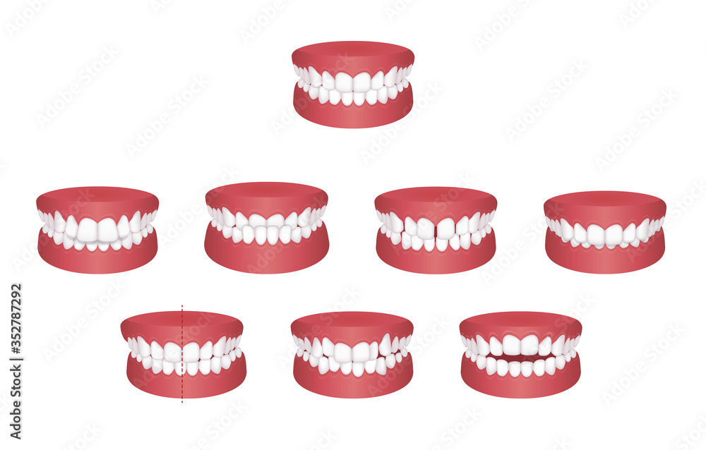 Teeth trouble ( bite type ) vector illustration set Stock Vector ...