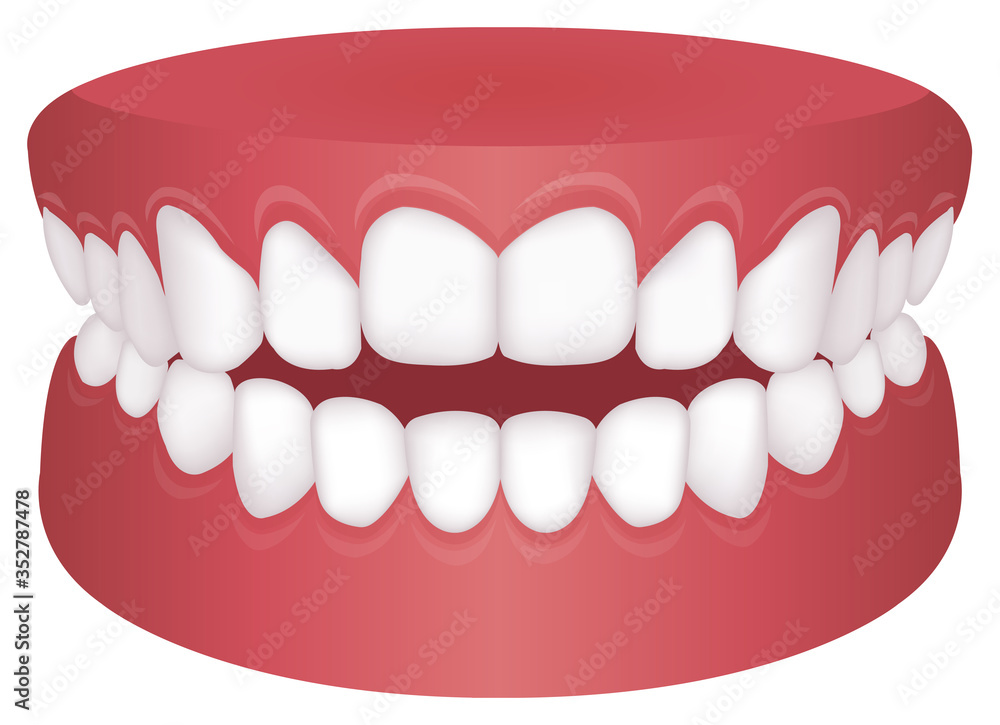 Teeth trouble ( bite type ) vector illustration /Open bite Stock Vector ...