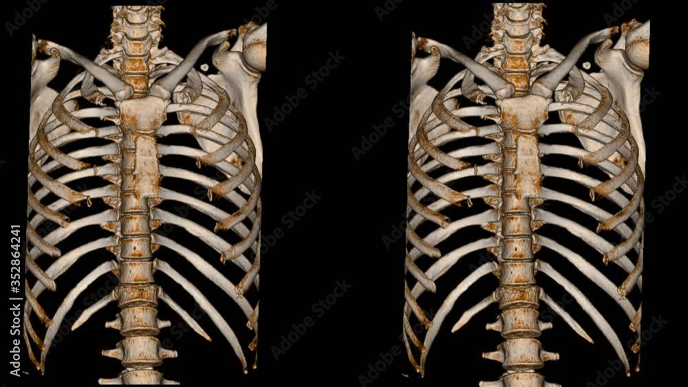 CT Scan Thoracic spine ct with 3D reconstruction . The film shown ...