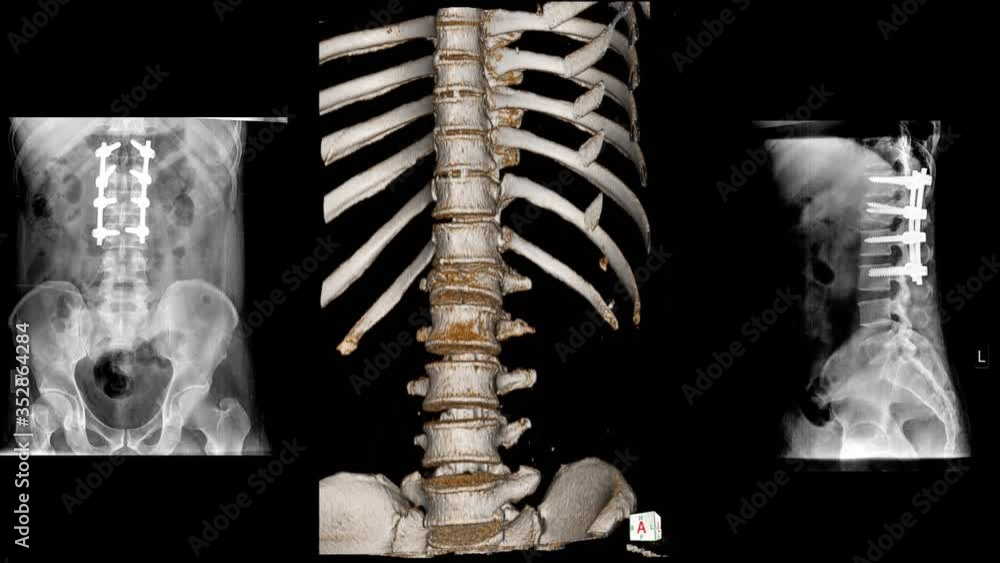 CT Scan Thoracic spine ct with 3D reconstruction . The film shown ...