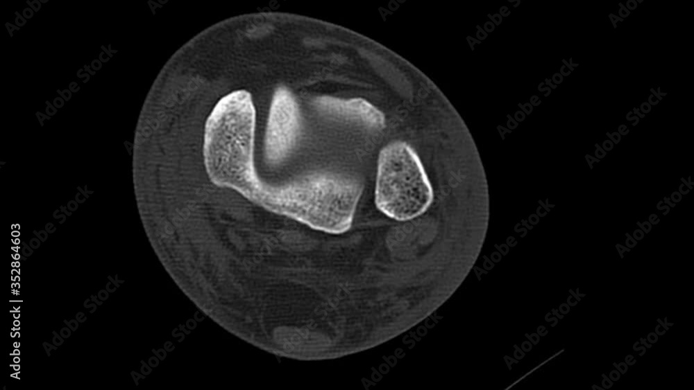 Film CT Scan foot showing heel bone broken (Calcaneus fracture) from ...