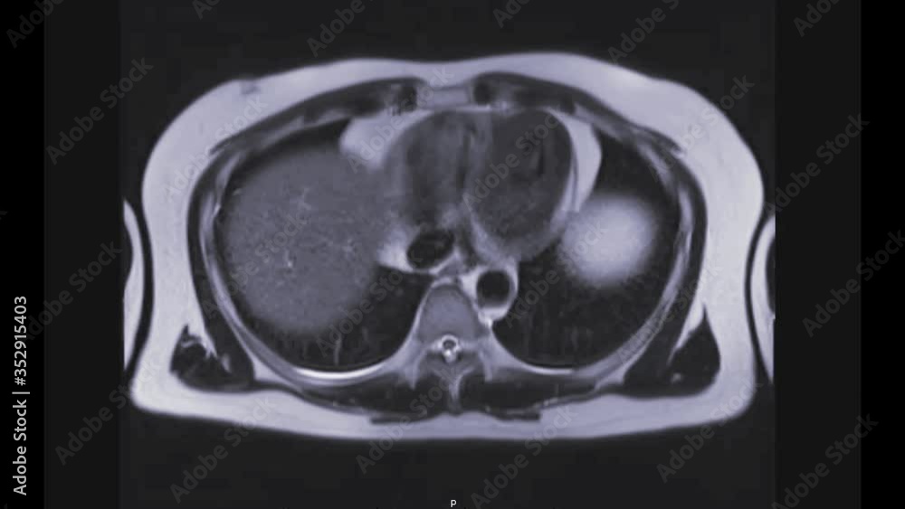 Vidéo Stock MRCP or Magnetic resonance cholangiopancreatography axial ...
