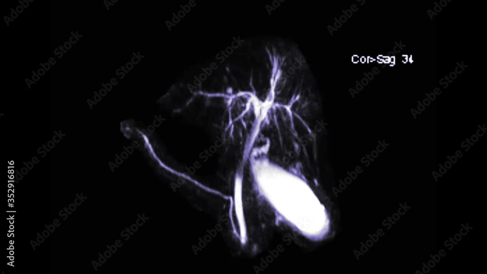 MRCP or Magnetic resonance cholangiopancreatography 3D MIP view showing ...