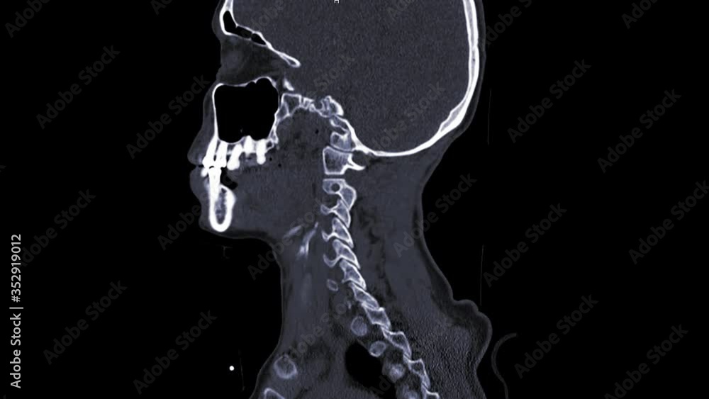 CT C-spine or Cervical Spine sagittal view of patient trauma case turn ...