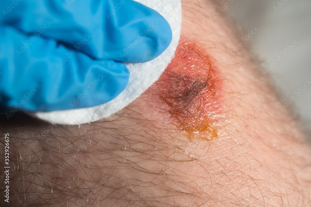 A wound on the knee after falling from the bike. Sports injury Stock Photo | Adobe Stock