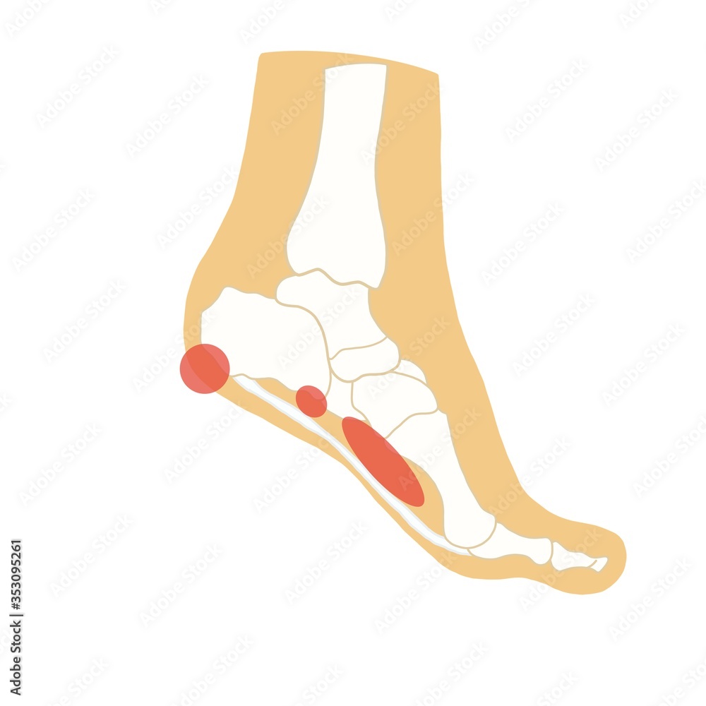 Painful Plantar fasciitis ligament feet disorder . Study education ...