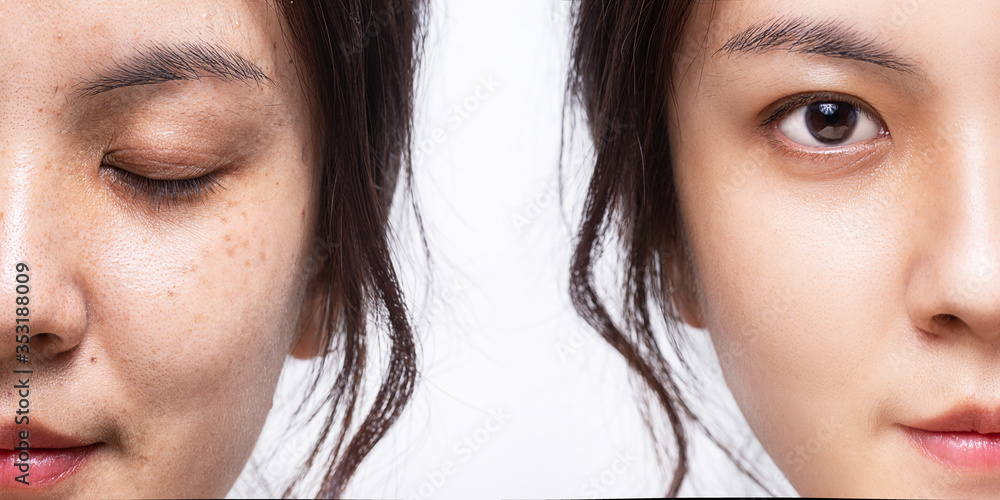 Comparison skin face, Closeup face of women before and after facial ...