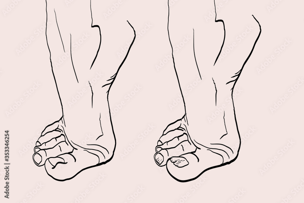 foot drawn with podiatry problems. Fingers and nails to be restored for ...