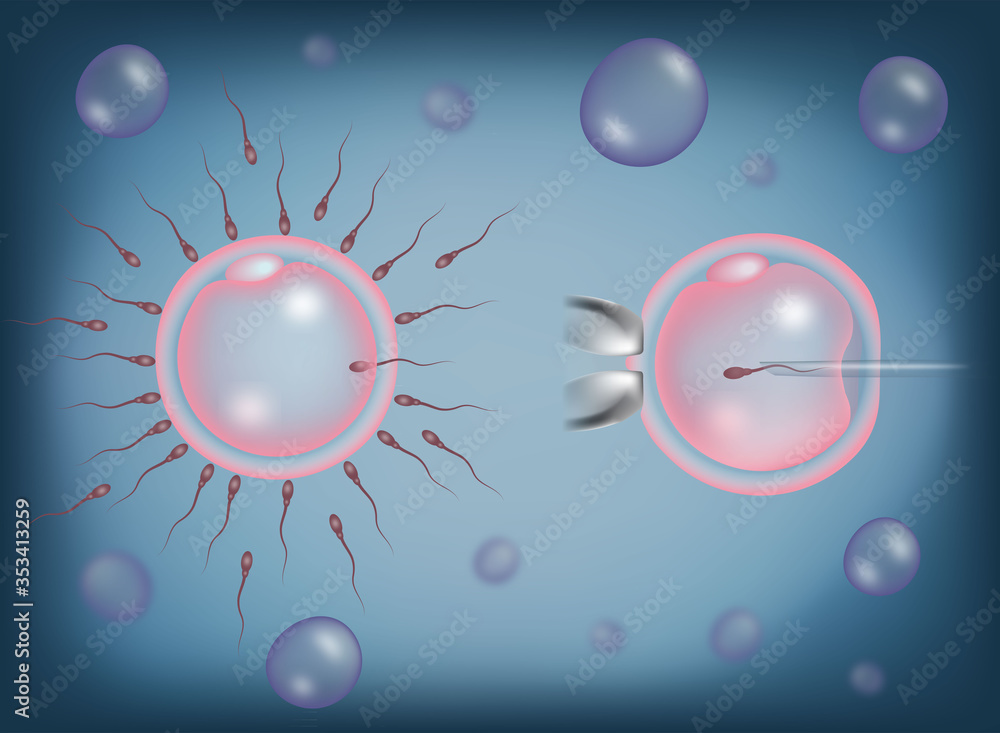 Intracytoplasmic sperm injection, ICSI, process versus In vitro fertilization process, IVF, 3D ...