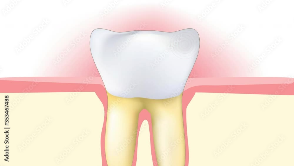 toothache. pain of the Molar or premolar tooth. 2D animation of ...