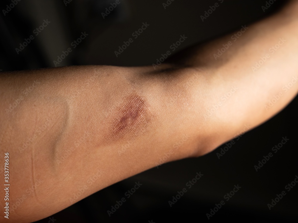 A burned wound in women's hand. first-degree heat burn scar on a woman ...