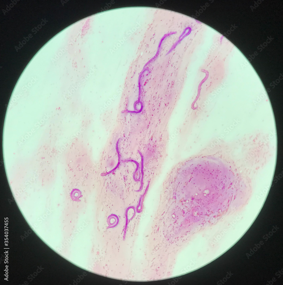 strongyloides stercoralis parasit in human. Stock Photo | Adobe Stock