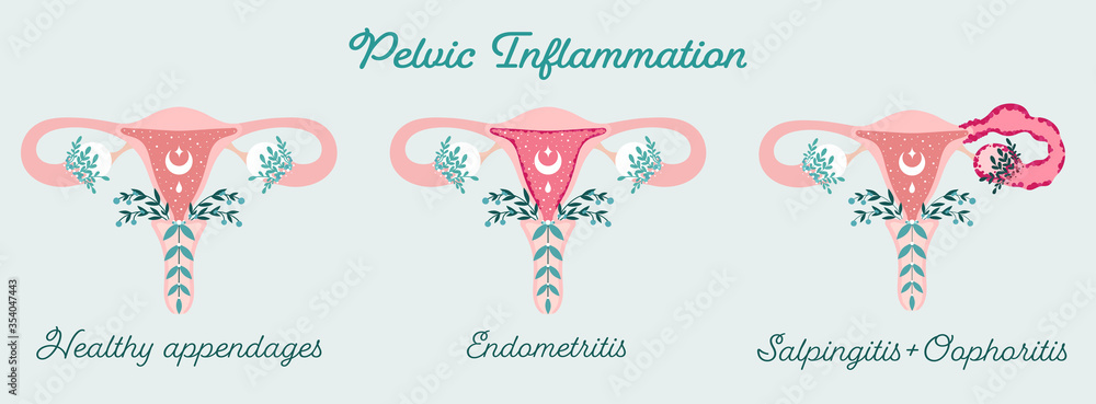 Pelvic Inflammation - Floral Infographic. Endometritis, Oophoritis ...