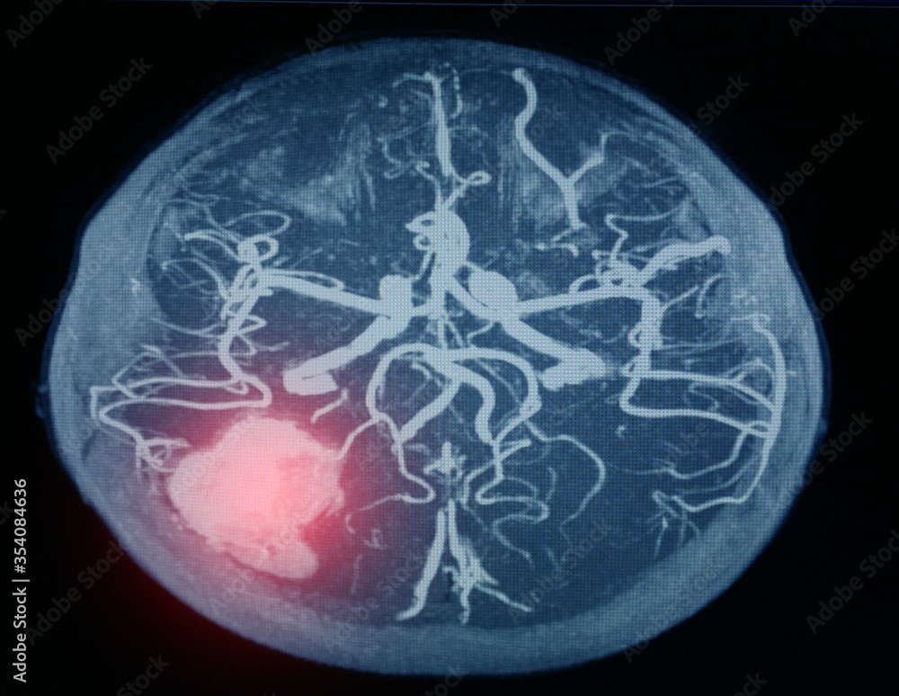 MRA brain or Magnetic resonance angiography image ( MRA ) of cerebral ...