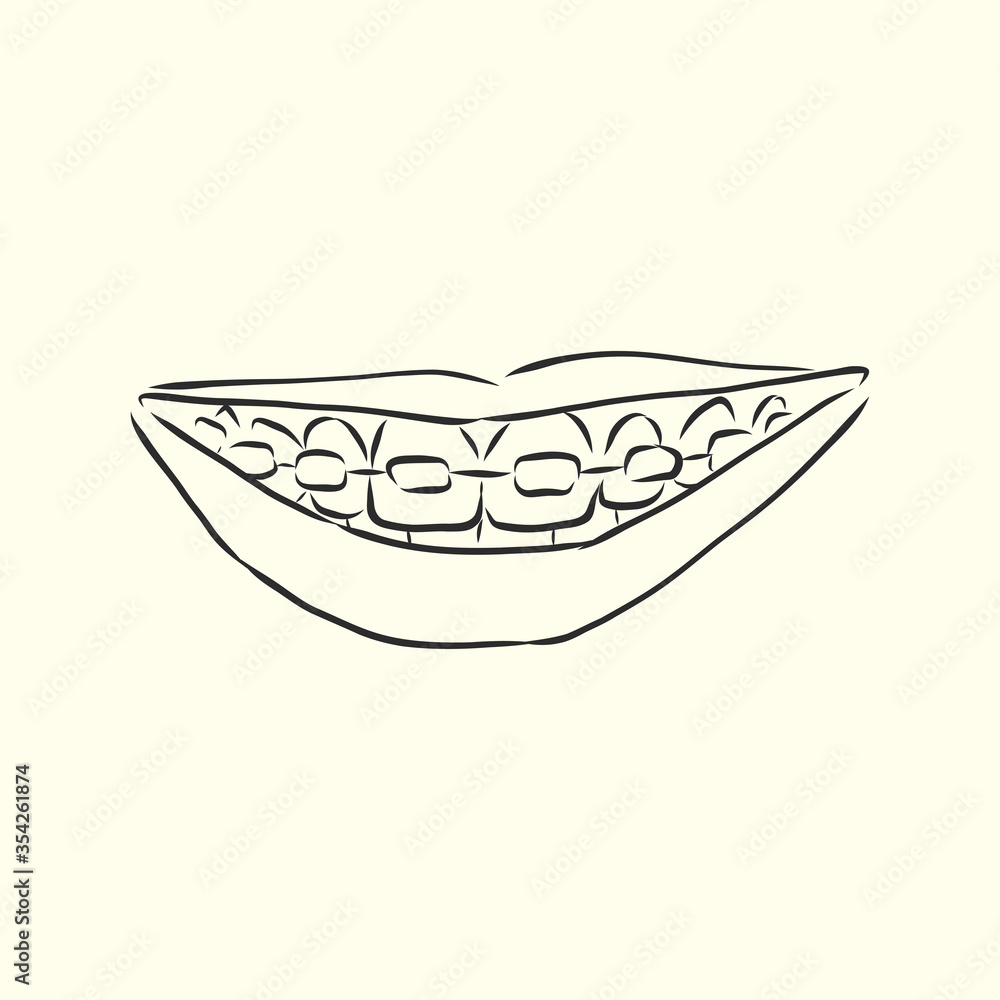 Dental braces hand drawn outline doodle icon. Dentistry, stomatology ...