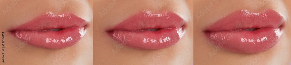 Lip correction procedure stages, banner design. Woman with beautiful ...