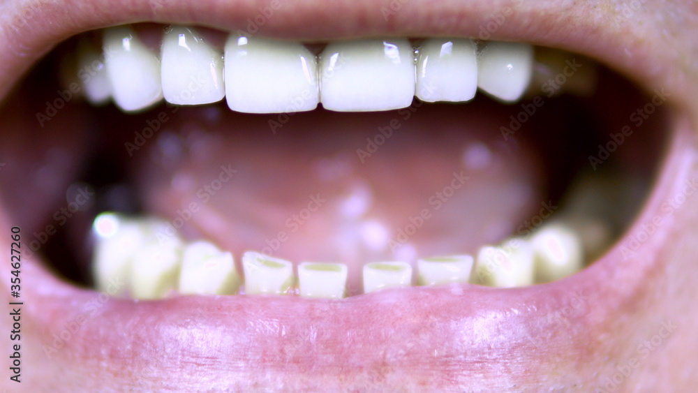 Old man shows teeth. The upper teeth are straight and the lower crooked ...