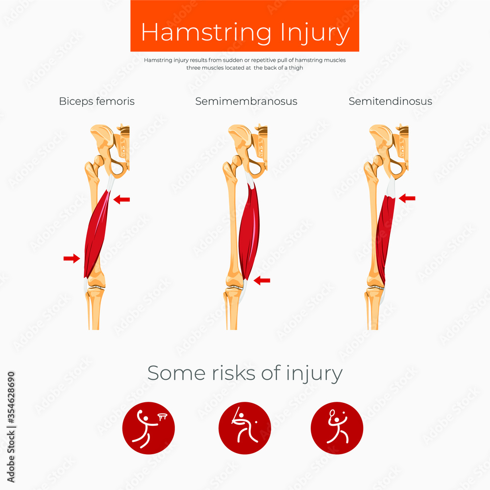 Hamstring injury anatomy scheme poster Stock Vector | Adobe Stock