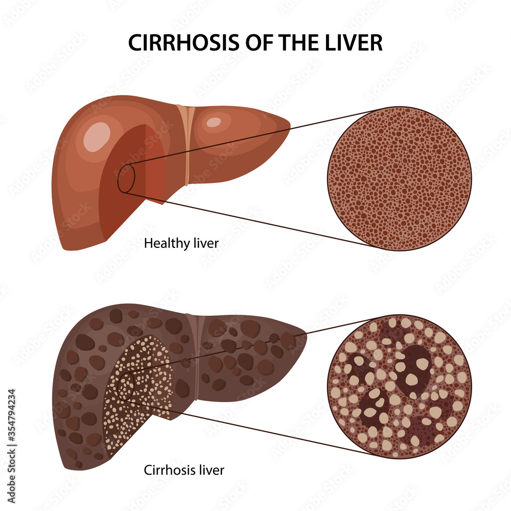 Cirrhosis of the liver. Histology of the healthy and cirrhotic liver ...