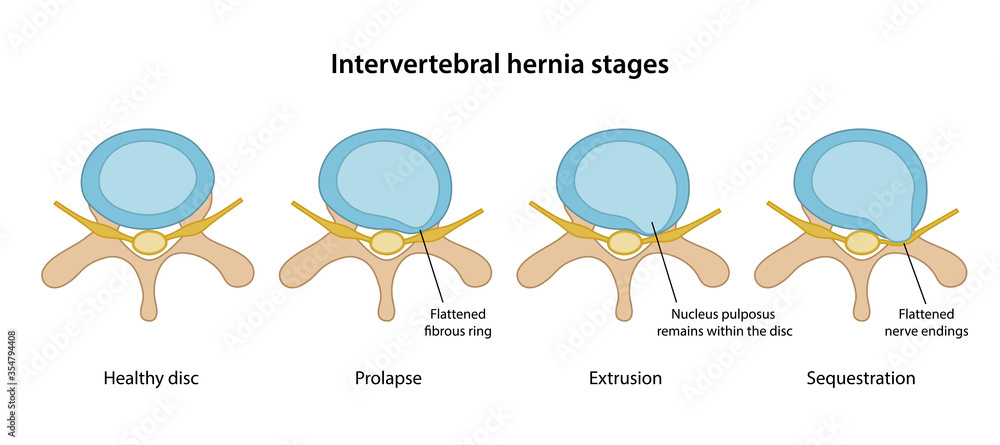 Intervertebral hernia stages: healthy disc, prolapse, extrusion ...