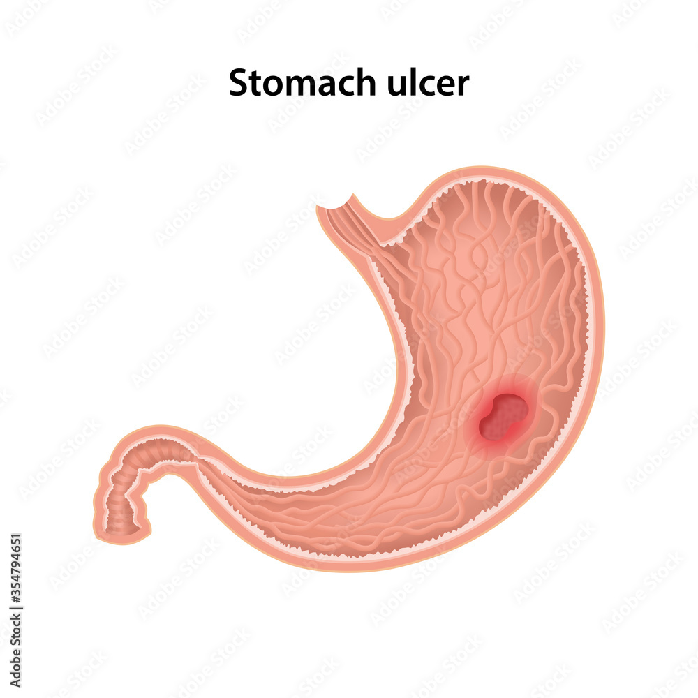 Stomach ulcer. Anatomical vector illustration of the stomach ulcer ...