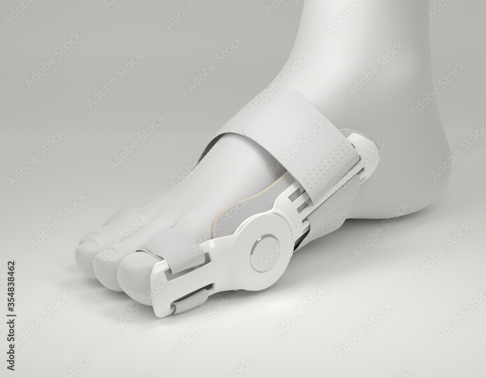 Feet wearing hallux valgus orthopedic pads on thumb toes. Bunion ...