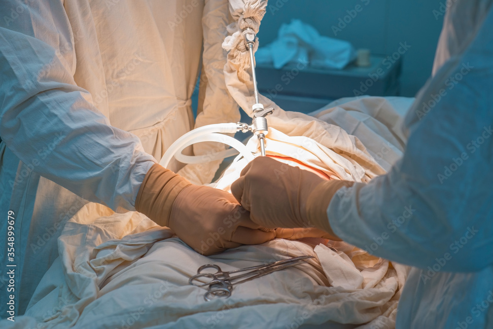 close-up hands of pediatric surgeons perform surgery using laparoscopic ...