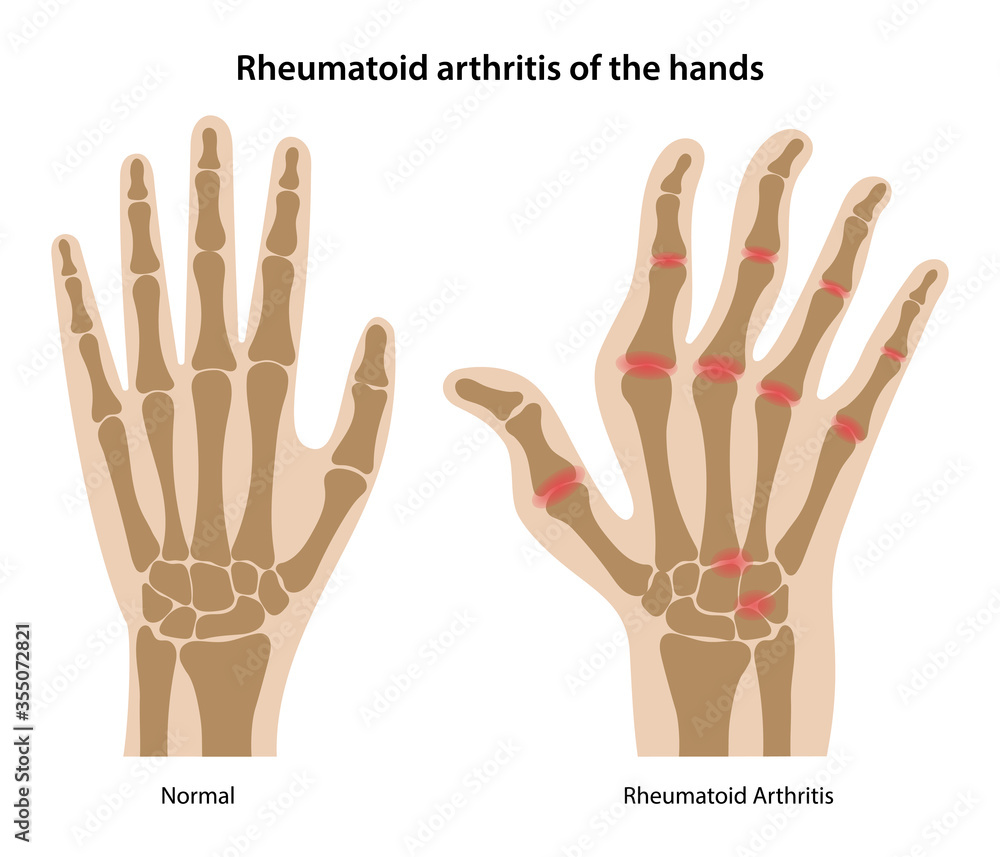 Rheumatoid arthritis of the human's hands. Silhouettes of healthy and ...
