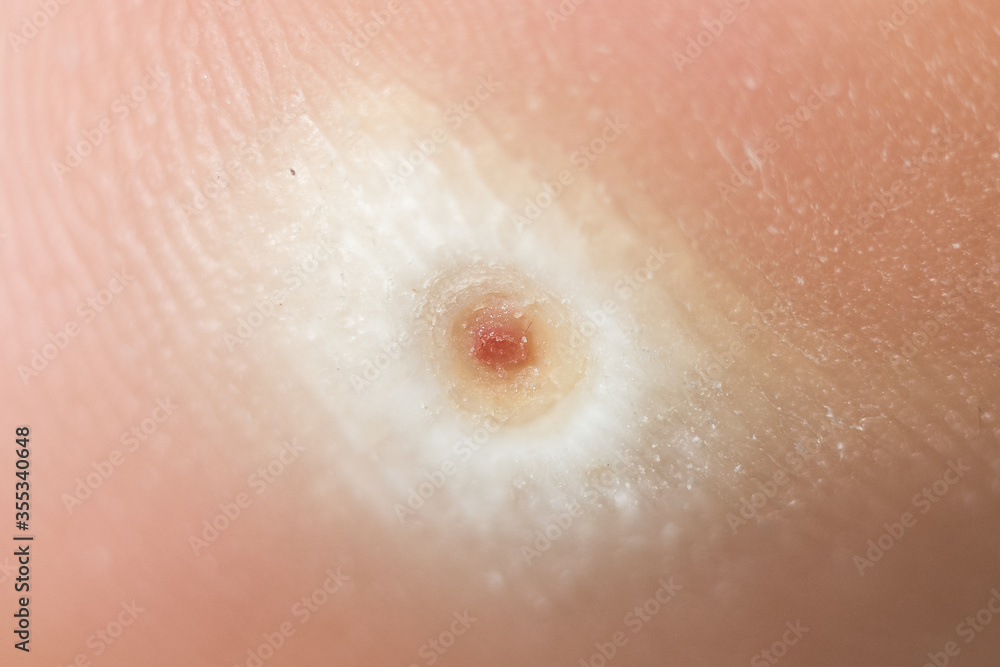 Plantar wart up close macro view. Small hard thickened callus around ...