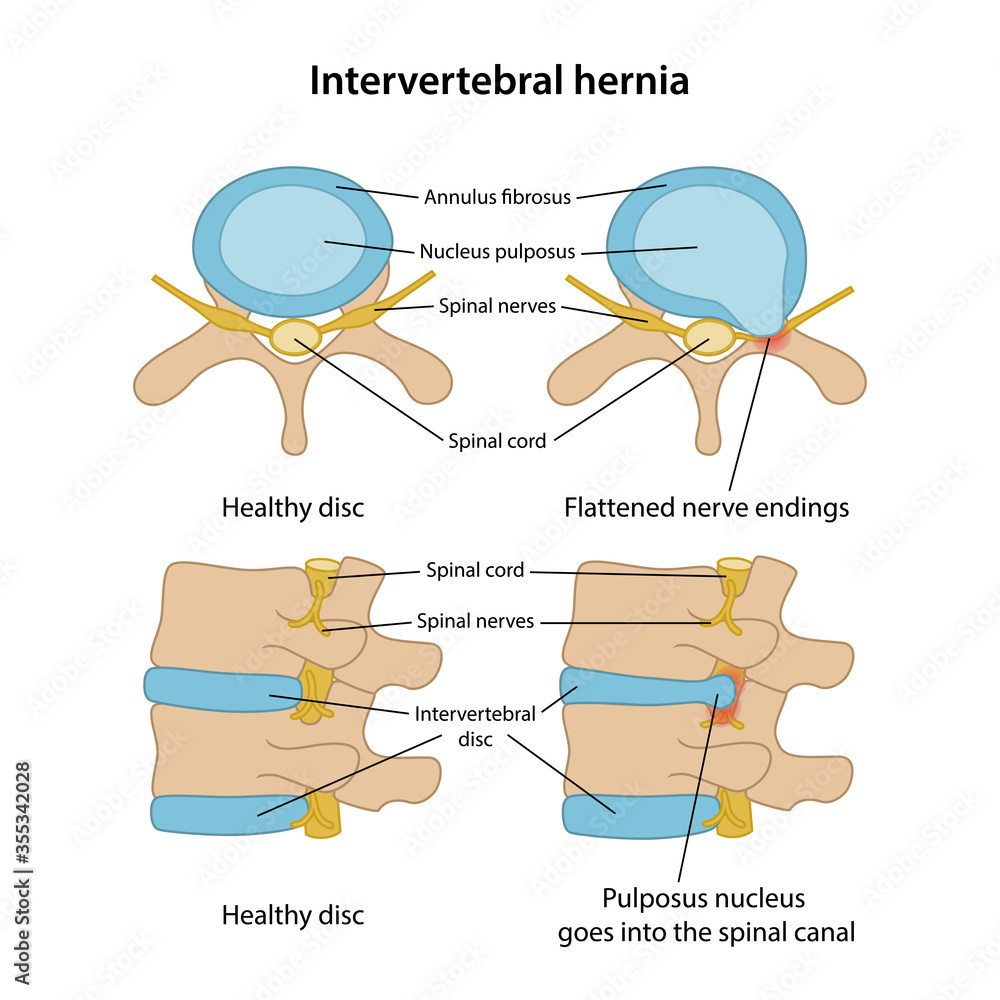 Intervertebral hernia with main description. Healthy disc and disc with ...