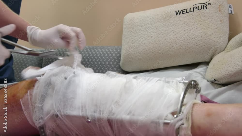 Man after surgery taken care of, leg with staples and stitches ...