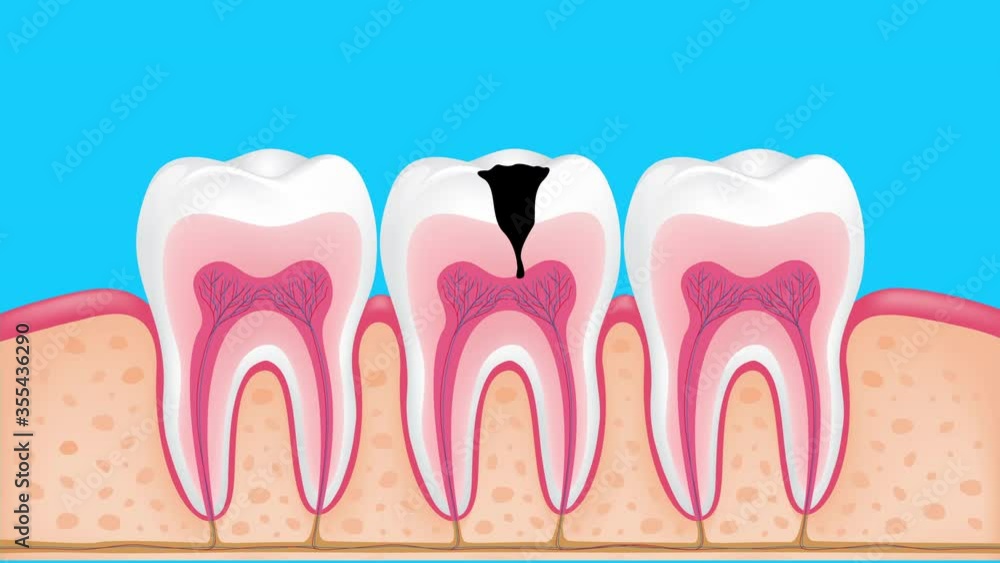 Stages of caries development. Enamel caries, Dentin caries, Pulpitis ...
