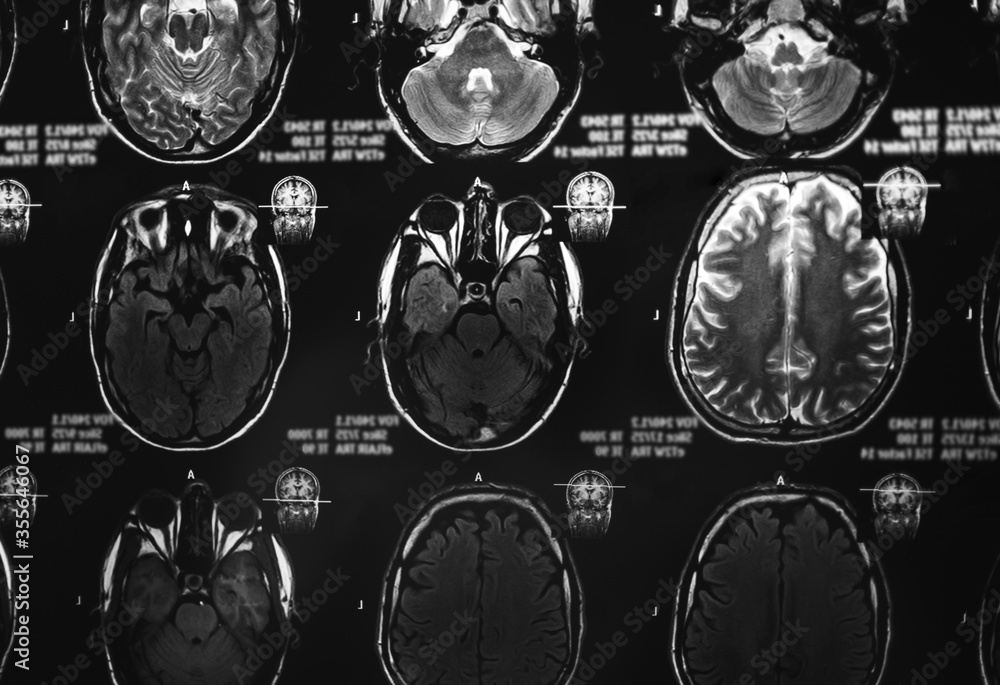 Magnetic resonance imaging. MRI head section, X-ray scan of the brain ...
