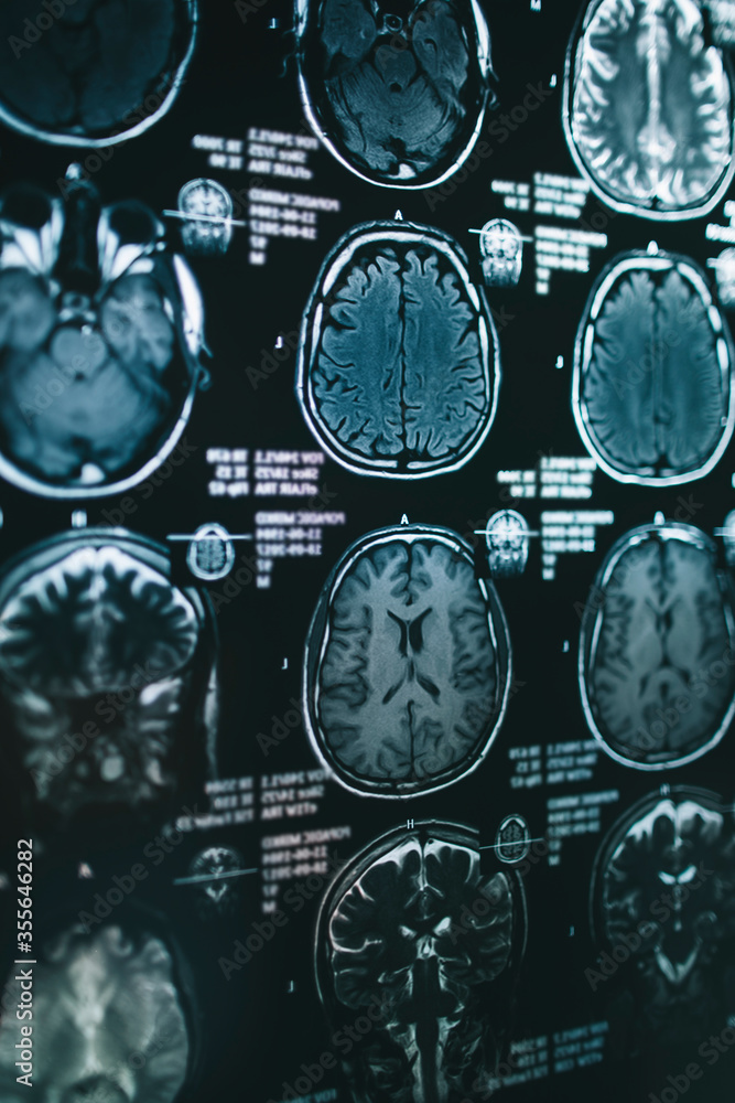X-ray scan of the brain. Magnetic resonance head scan Stock Photo ...