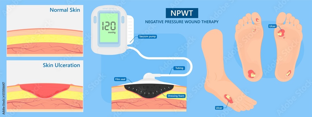 Vacuum assisted closure VAC drain tube treat dead damage pain medicine ...