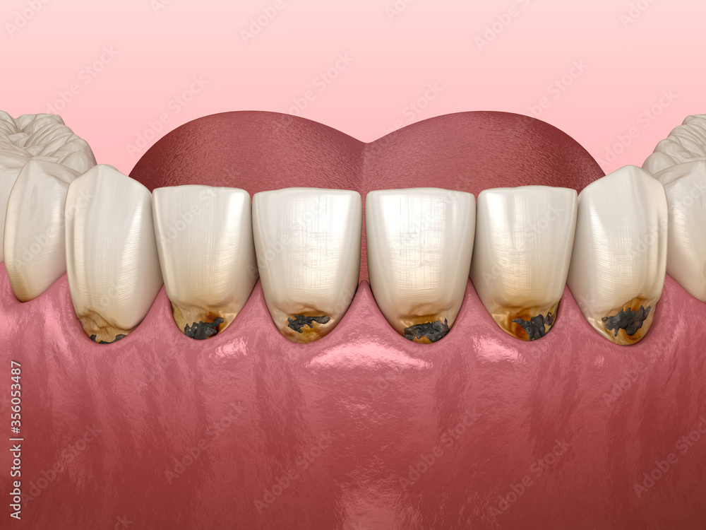 Cervical caries on frontal teeth. Medically accurate tooth 3D ...