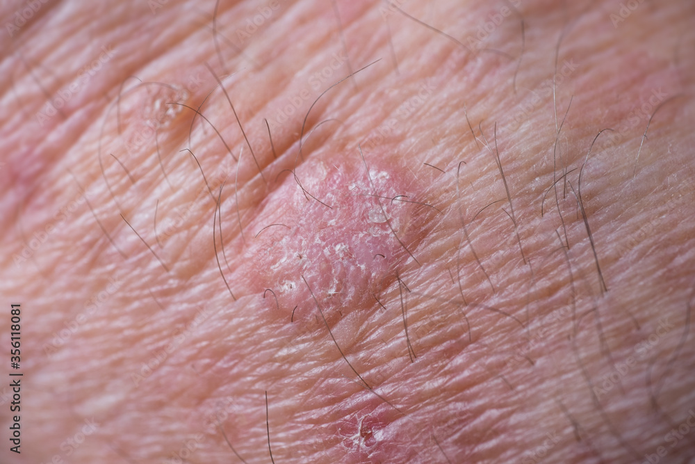 Stockfoto Crude eczema with redness, swellings, bumps and flakes on the ...