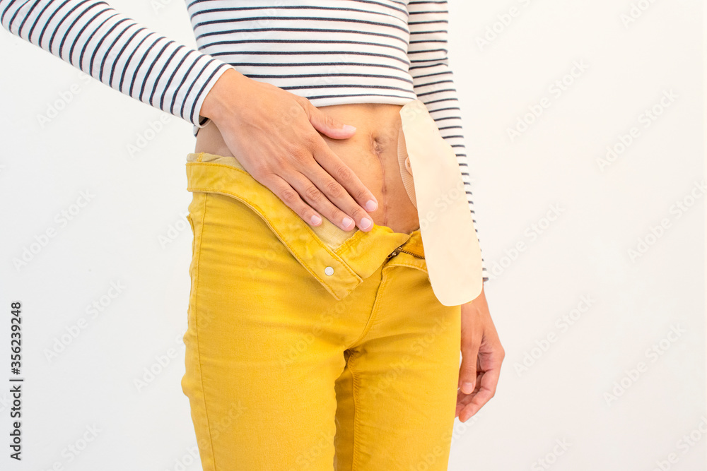 Colostomy Bag On A Person