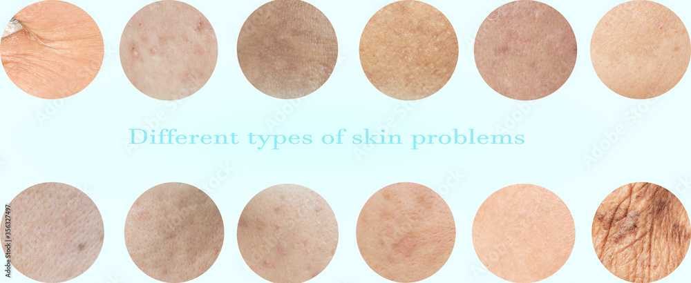 Different types of skin problems and wrinkles around the eyes and face ...