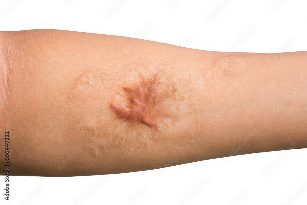 Poster Close up Keloid scar (Hypertrophic Scar) on man arm skin after ...