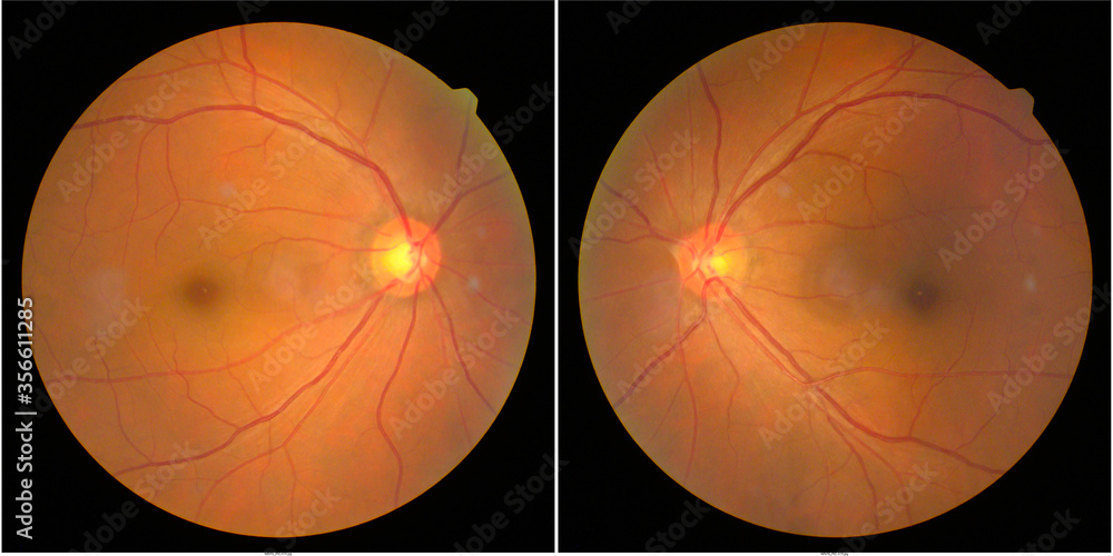 retinal images Stock Photo | Adobe Stock