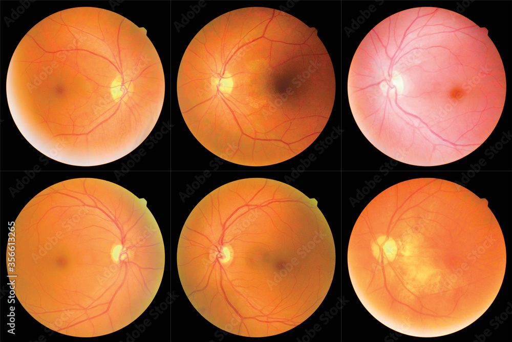 retinal images Stock Photo | Adobe Stock