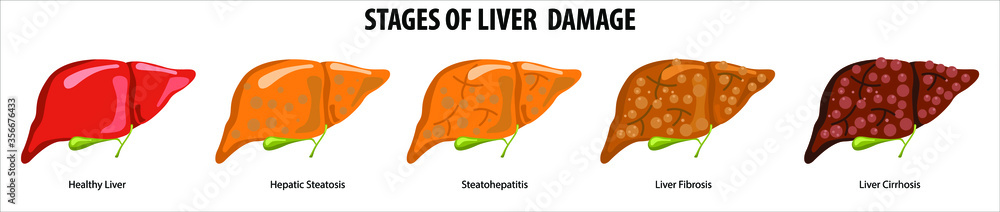 Stages of liver damage. Liver Disease. Healthy, fatty, liver fibrosis ...