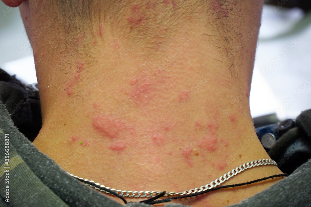 Red skin rash on the neck. Allergic reaction on the skin Stock Photo ...