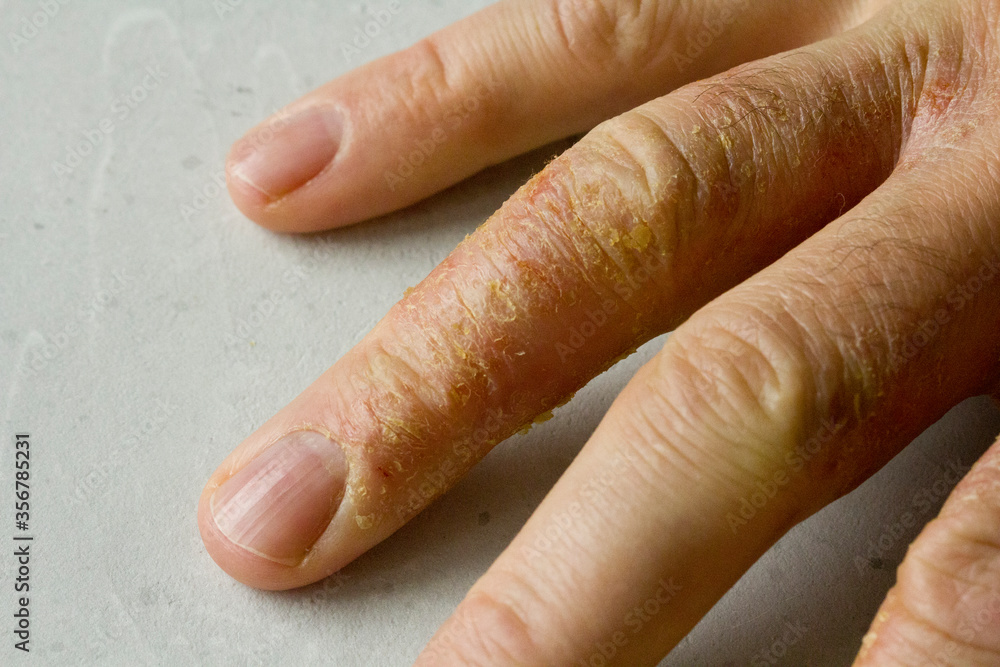 Dermatitis On Fingers