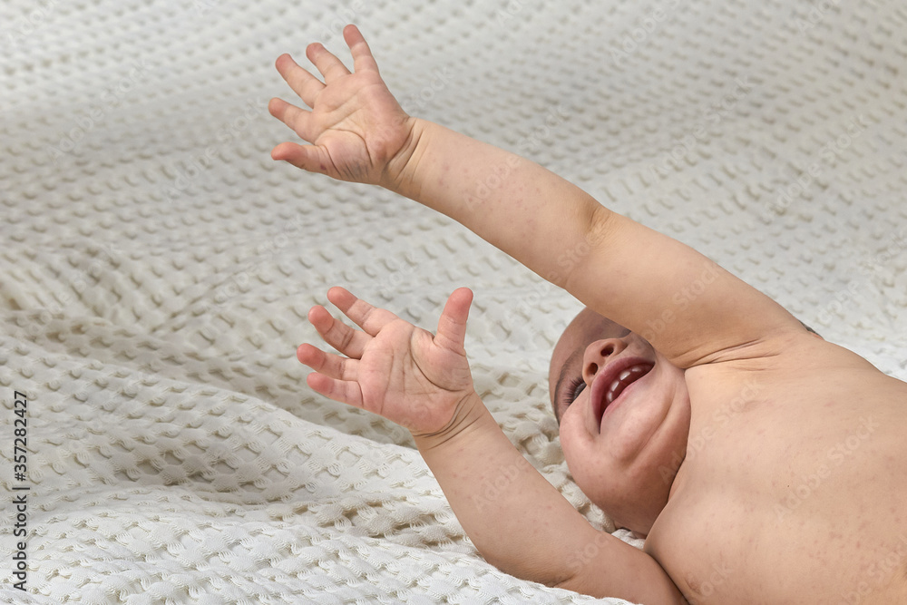 roseola rash a viral rash on the skin of a child Stock Photo | Adobe Stock