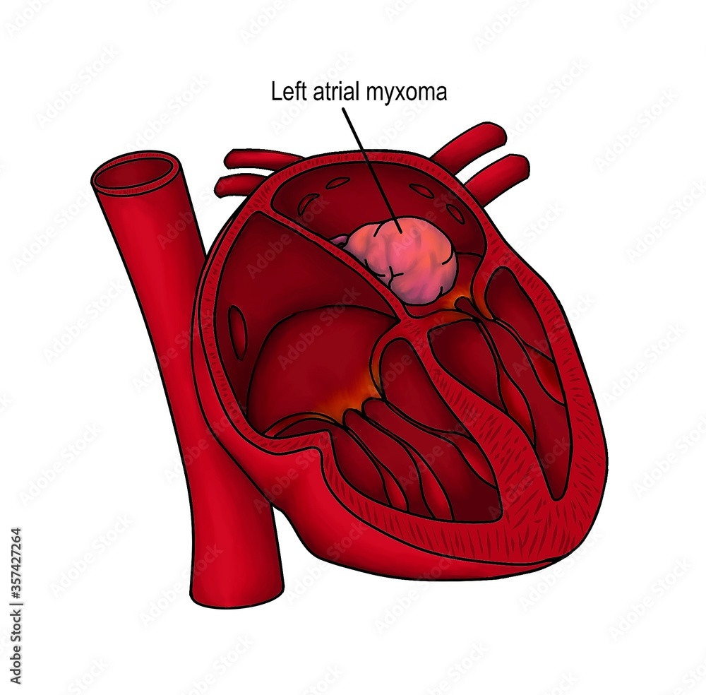 Atrial myxoma is the tumor of humna's heart which is the one of ...