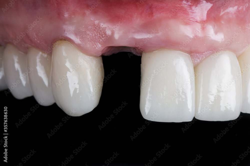 missing tooth on the maxilla of the patient before implantation and ...